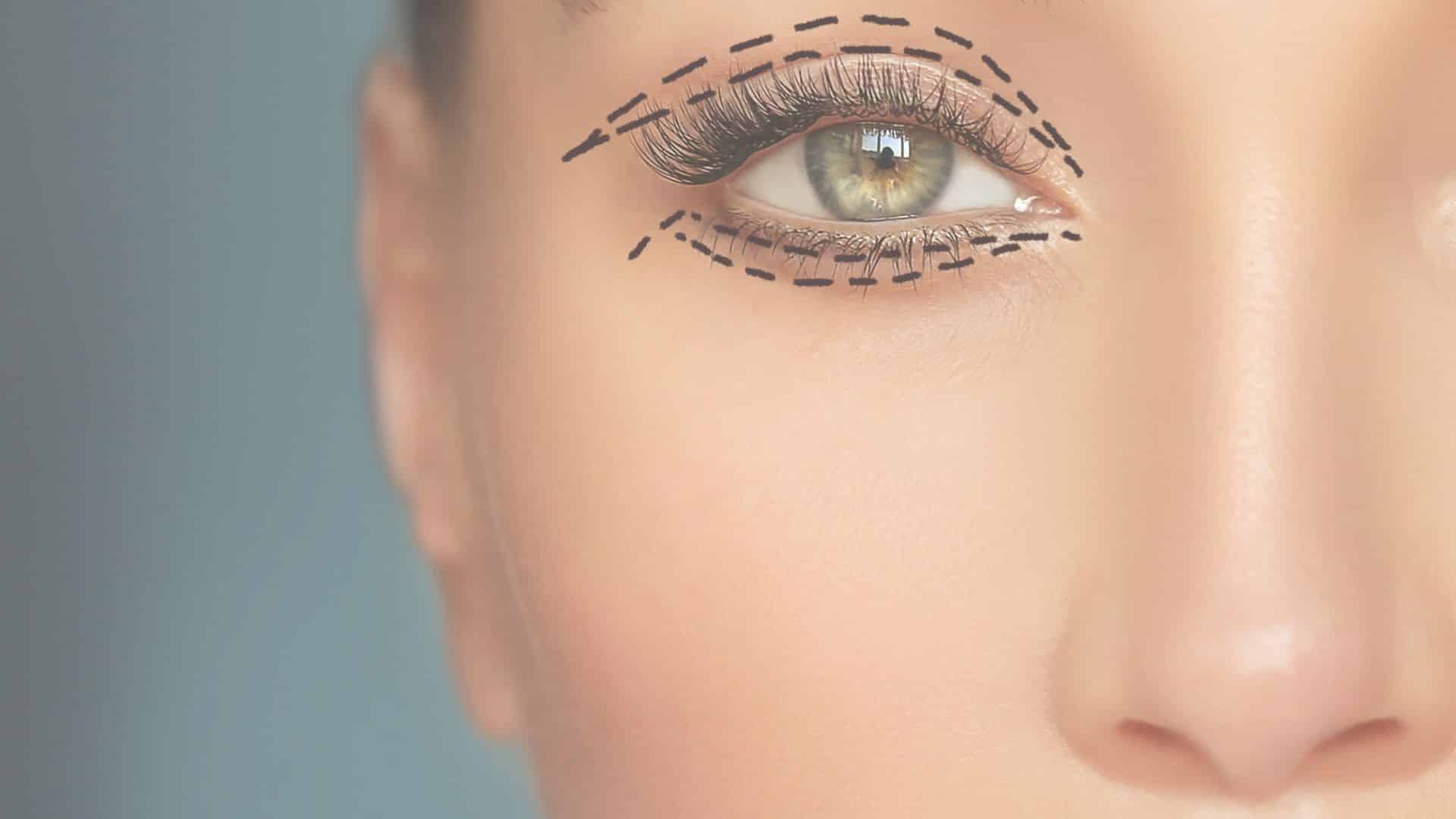 Blefaroplastia: Conheça o procedimento e seus benefícios - Clínica Versato